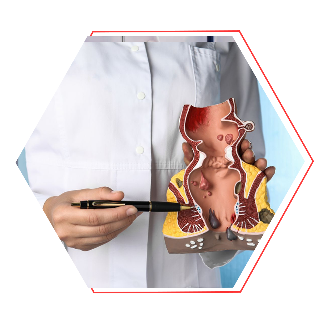 Find the Best Fissure Treatment in Delhi - Dr. Piles Clinic